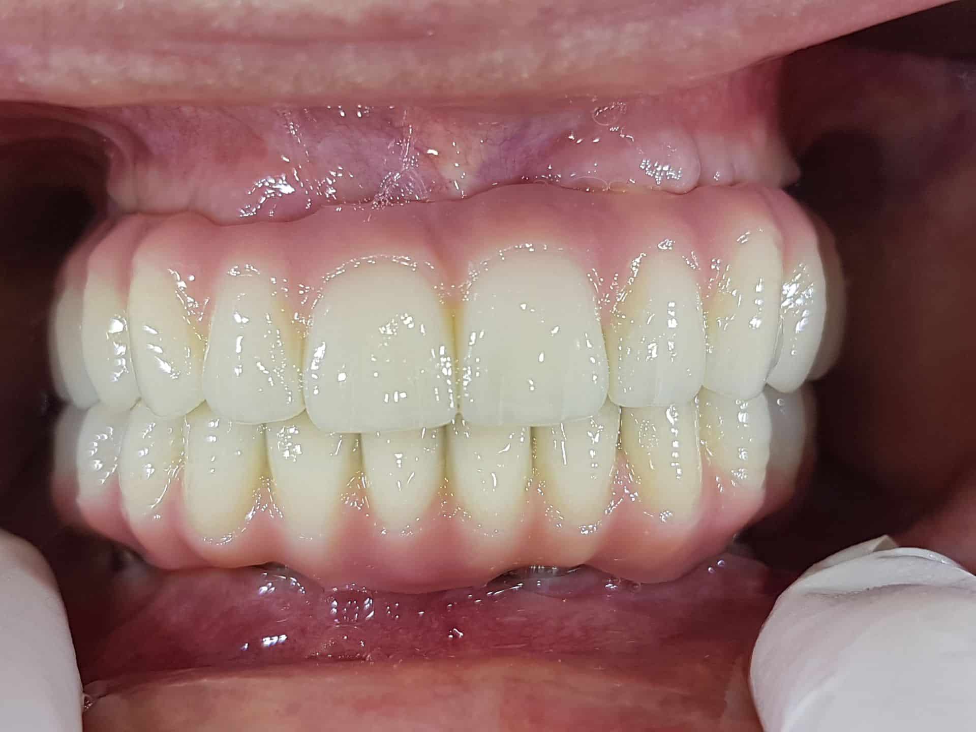 All on 4 - Dental Centar Ostojić